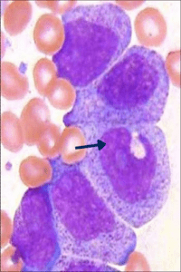 Leukemia – Acute Myeloid – AML | Tennessee Oncology