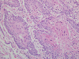 Lung Cancer | Tennessee Oncology